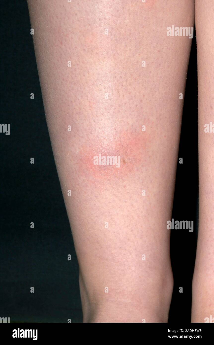 Erythema nodosum rash (red area, centre) on a 16-year-old girl's leg ...