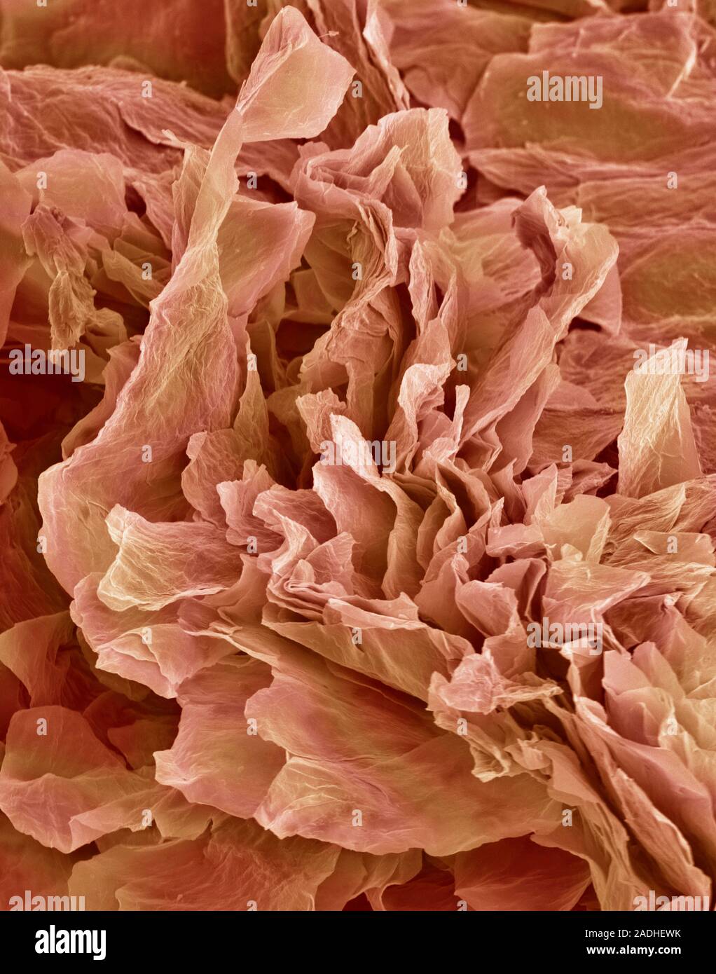 Eczema, coloured scanning electron micrograph (SEM). Eczema is a form ...