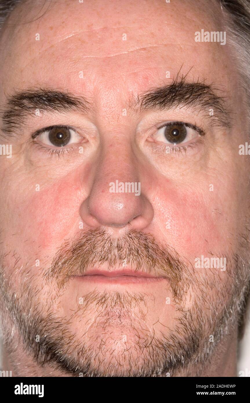 Eczema on face. Seborrhoeic eczema and rosacea on the face of a 51 year ...