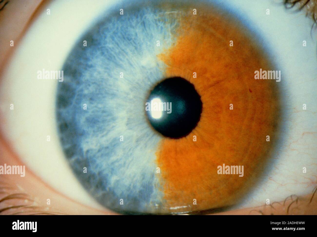 Benign conjunctival pigmentation: close-up of the eye showing the iris ...