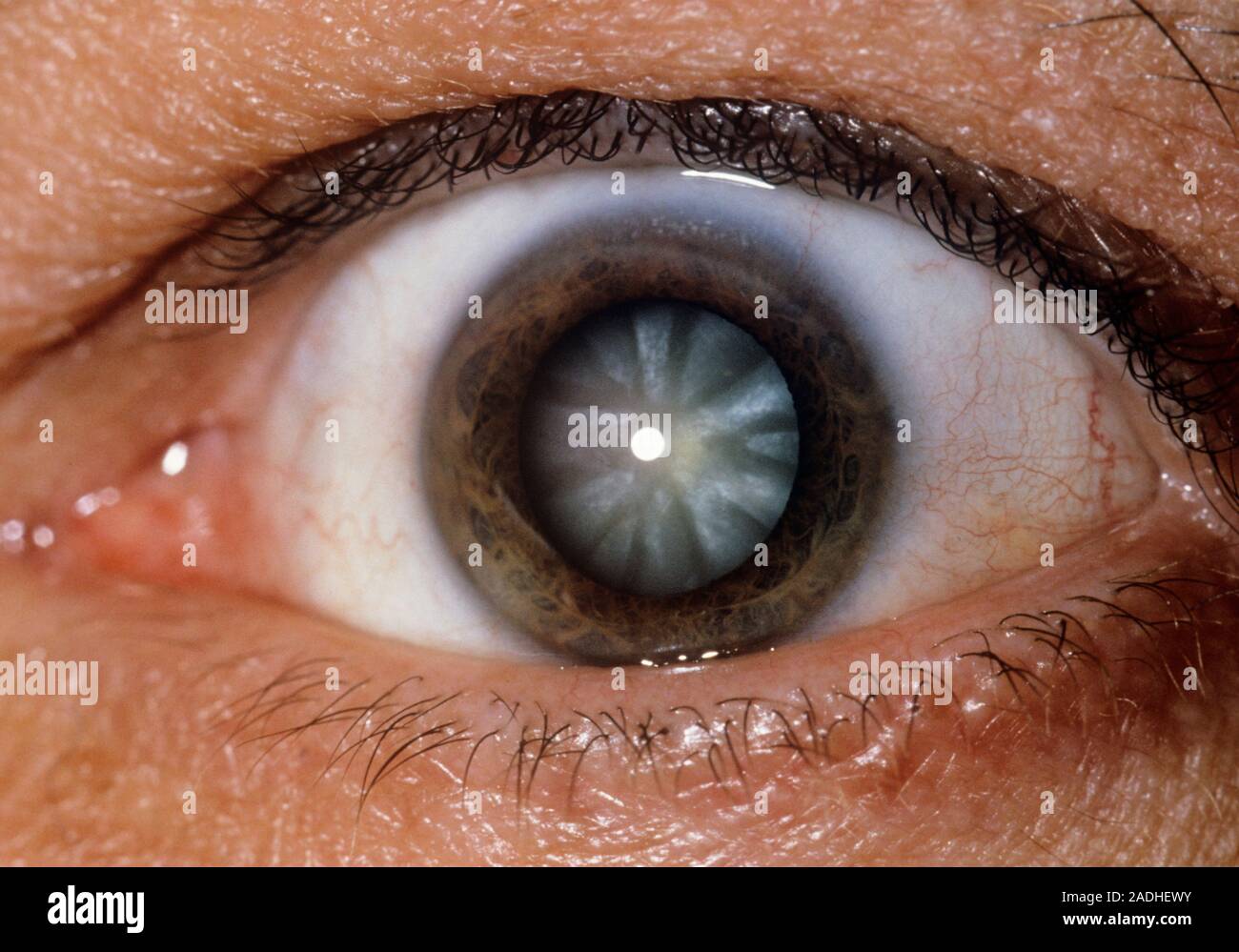 Close-up of the eye showing a cataract, an opacity in the lens of the ...