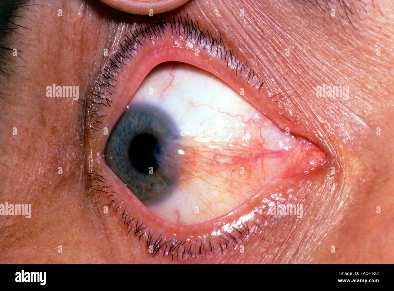 Pterygium, an overgrowth of the cornea, usually on the inner side of ...
