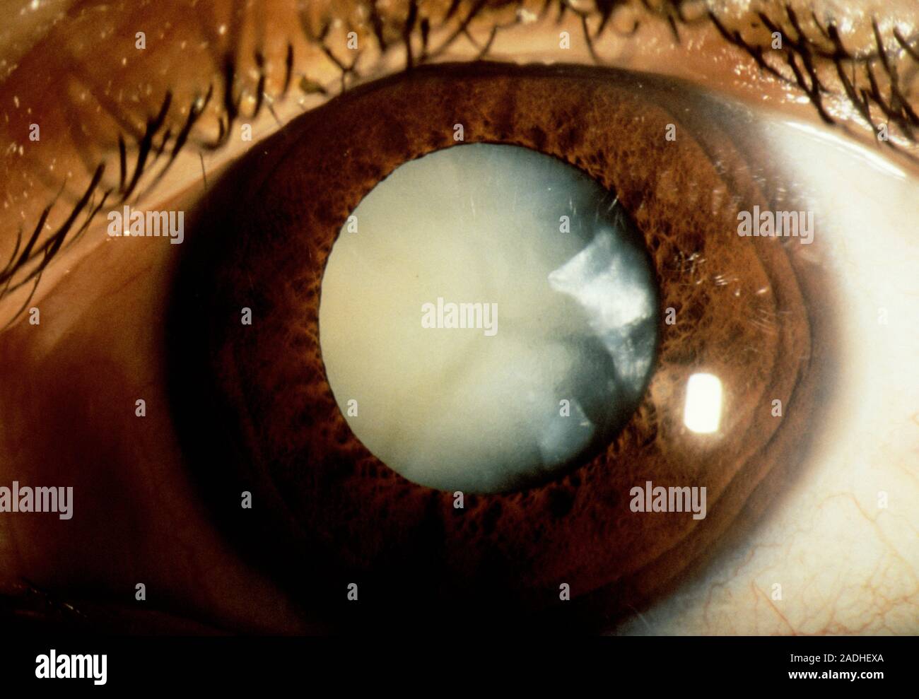 Close-up of the eye showing a mature cataract. Cataract is a general ...