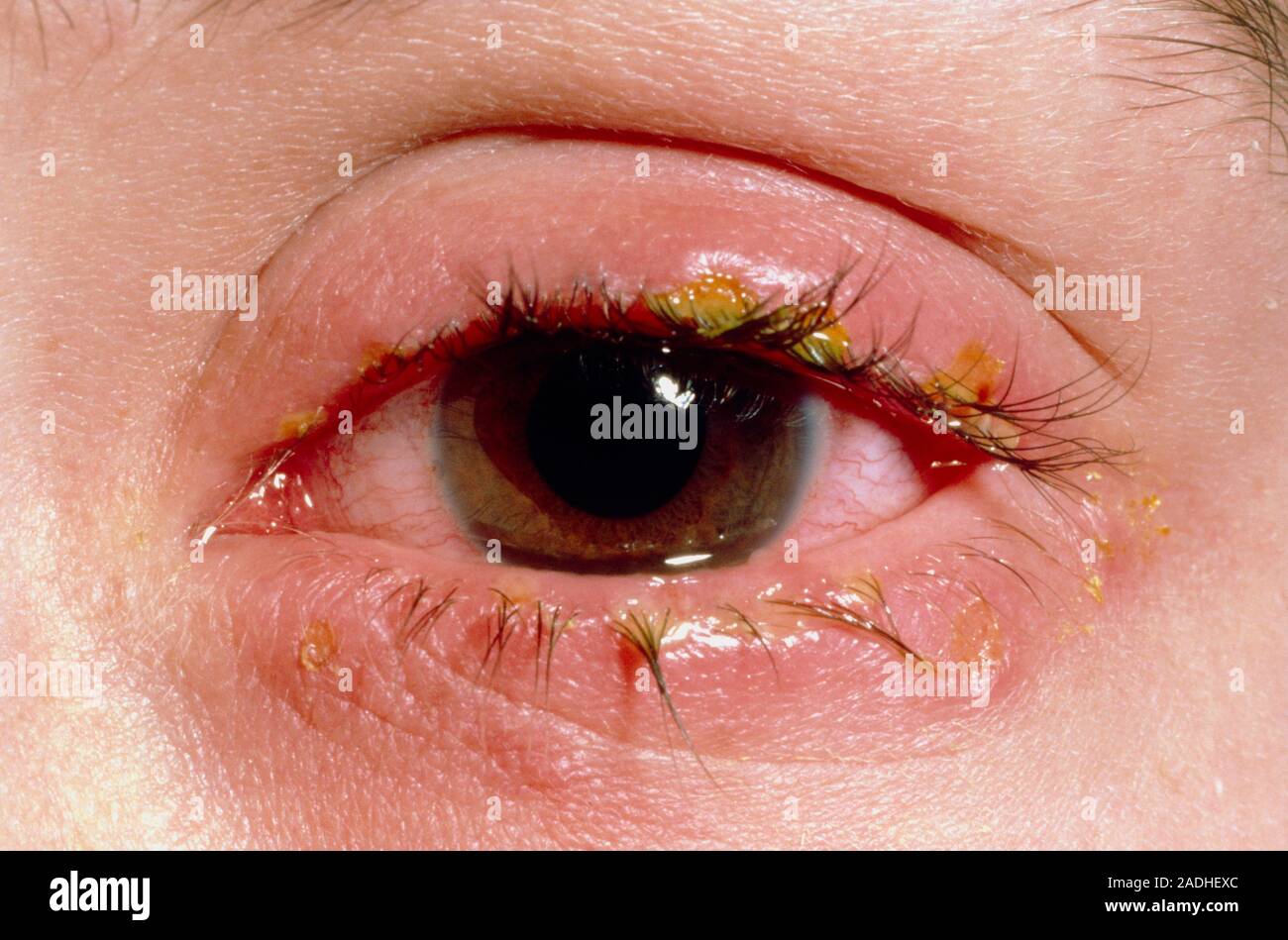 Blepharitis, the inflammation of the eyelids due to herpes simplex ...