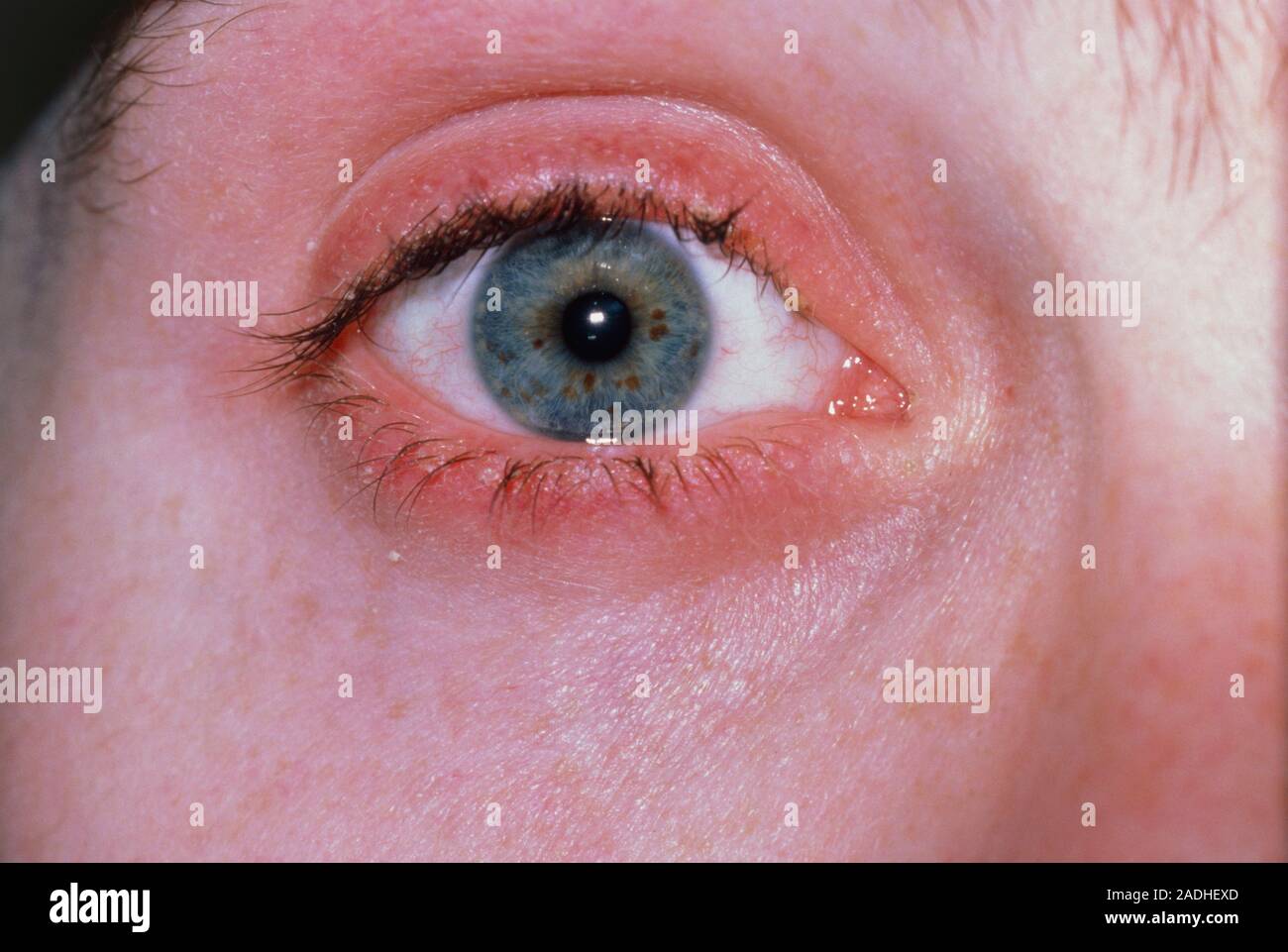 Macrophotograph of the eye showing blepharitis, the inflammation of the ...