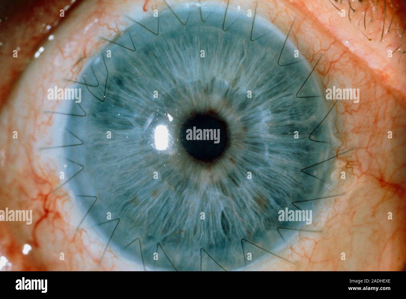 Close-up photograph of a person's eye following a corneal graft ...