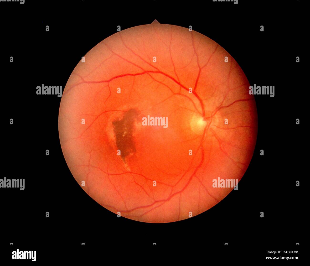 Detached retina: the separation of the retina from the choroid, the ...