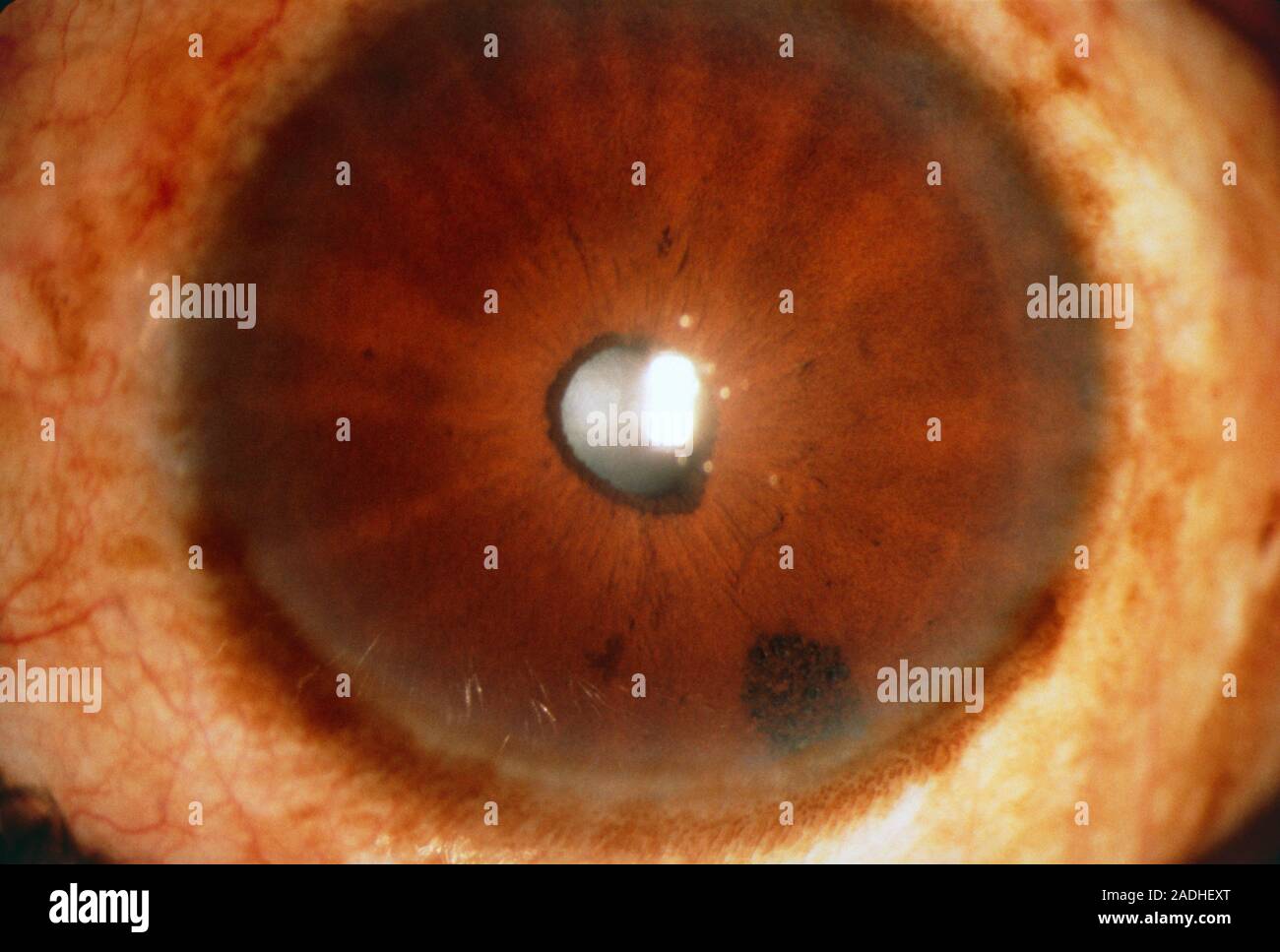 Close-up of the eye showing a trabeculectomy scar on the iris, the ...