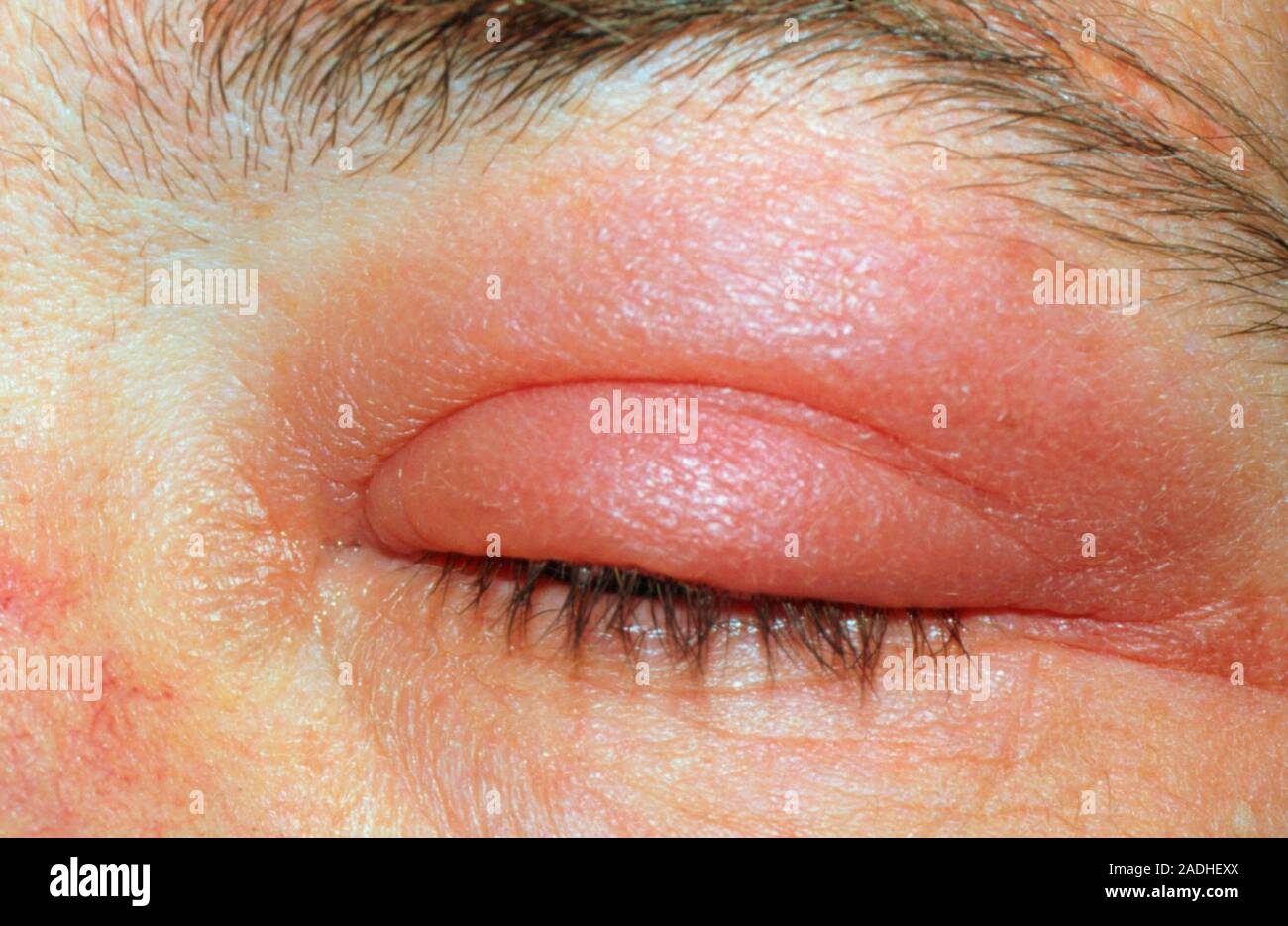 Erysipeloid eye infection, showing a close-up of oedema (swelling ...