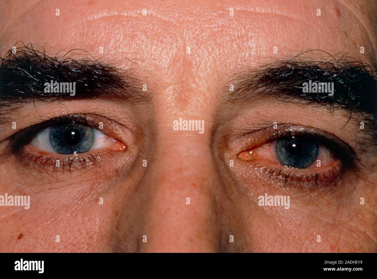 Man with acute iritis, inflammation of the iris, in his right eye ...