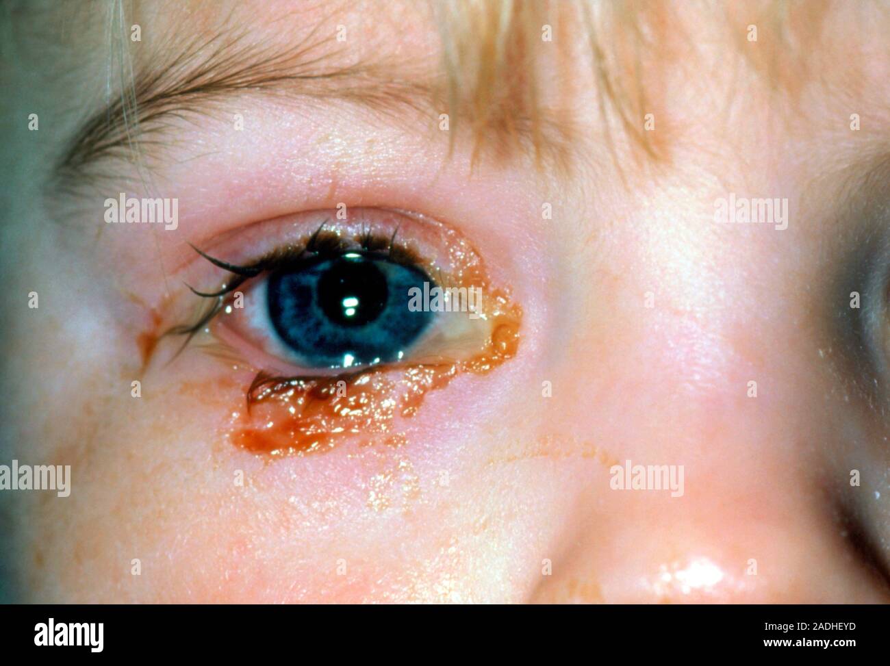 Dicharge from a child's eye in acute bacterial conjunctivitis, an ...