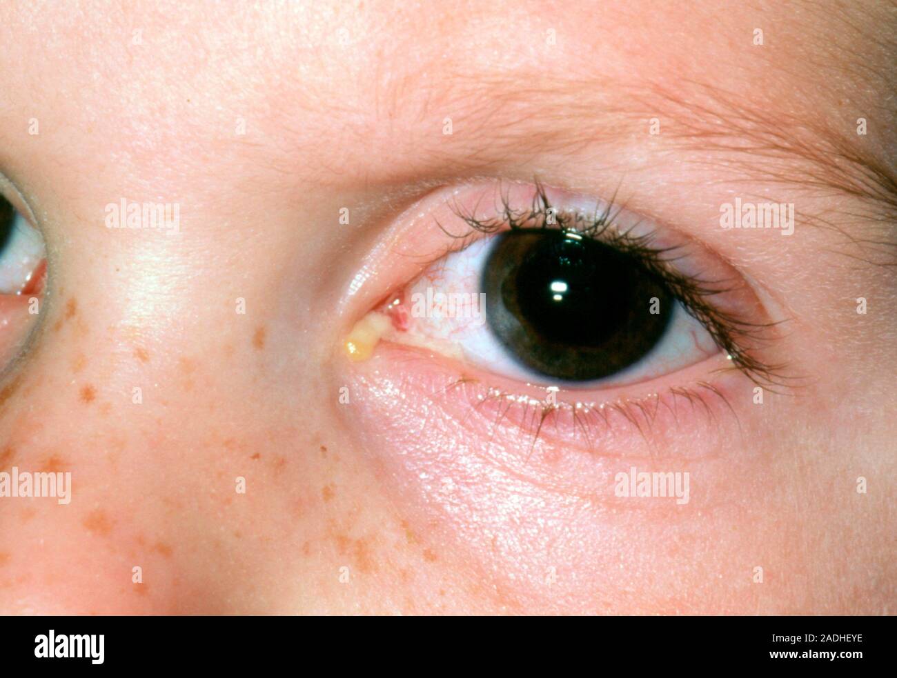Dicharge from a child's eye in acute conjunctivitis, an inflammation of ...