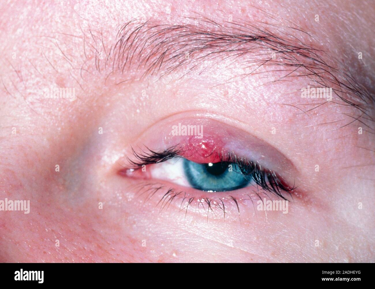 A Chalazion Or Meibomian Cyst On The Eyelid A Swollen And Inflamed Sebaceous Gland That Results