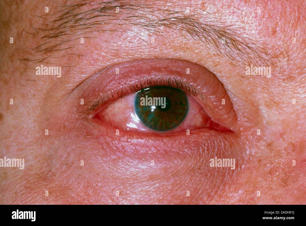 Acute allergic conjunctivitis: inflammation of the conjunctiva, the ...