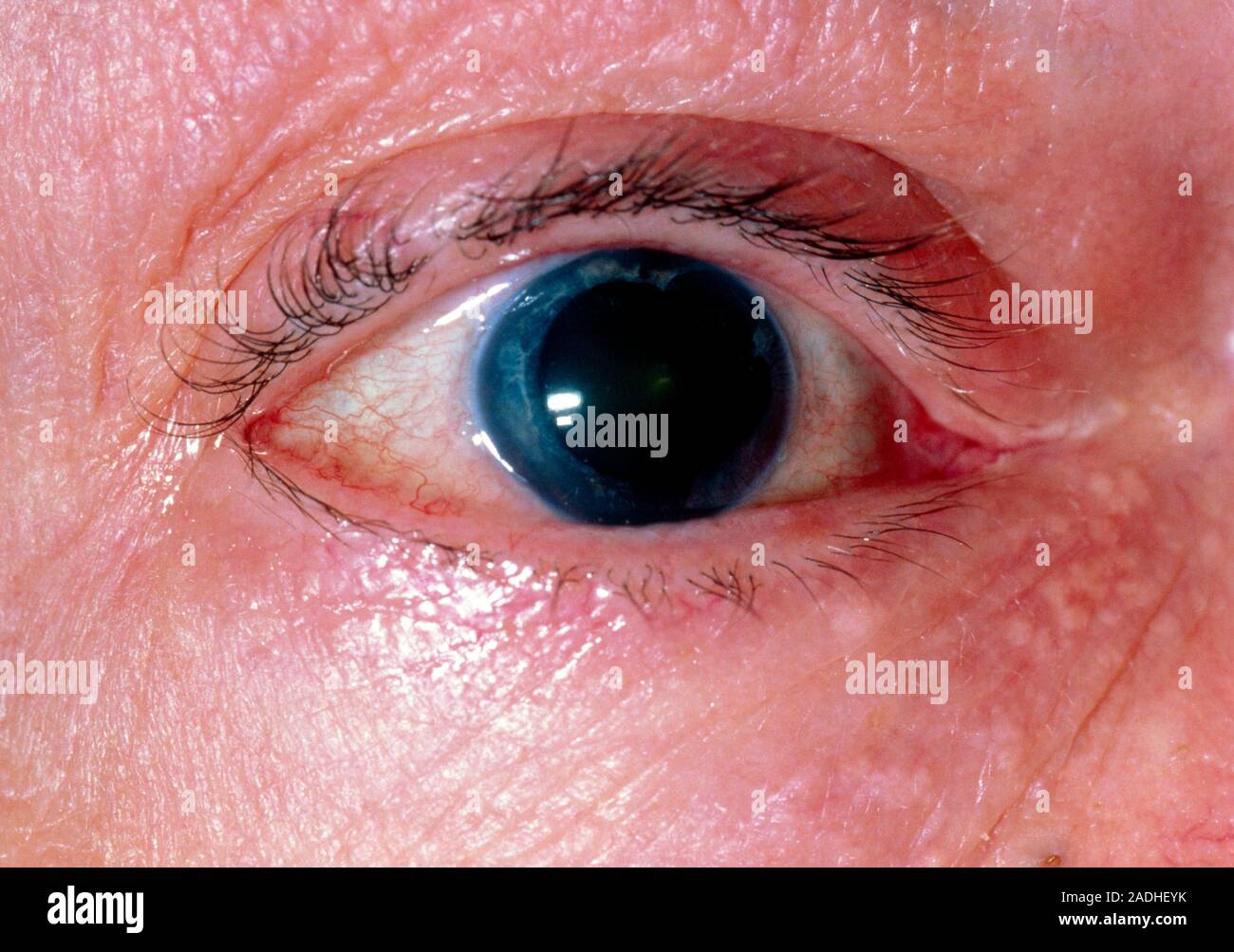 Close-up of the eye showing its changed appearance following a ...