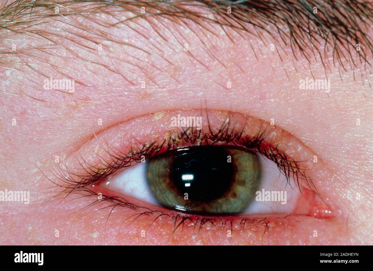 Blepharitis, showing scaling of the skin at the base of both the upper ...