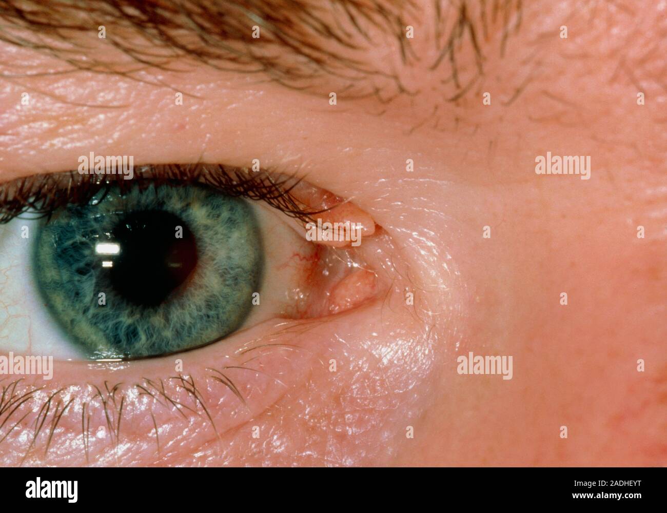 Eyelid Warts Verruca