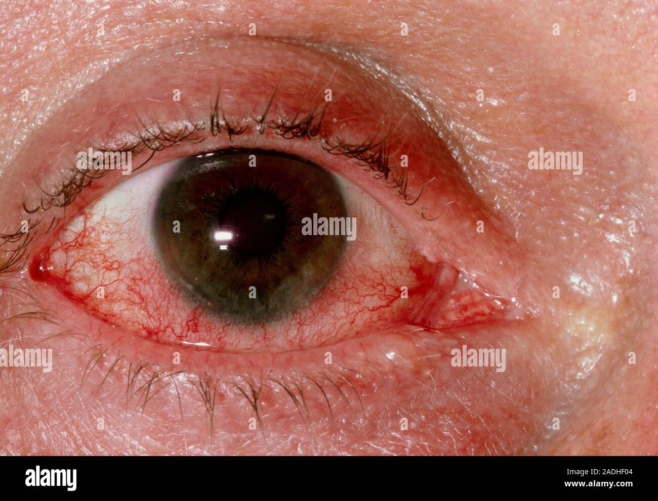 Eye infection. Close-up of an eye affected by viral conjunctivitis. The ...