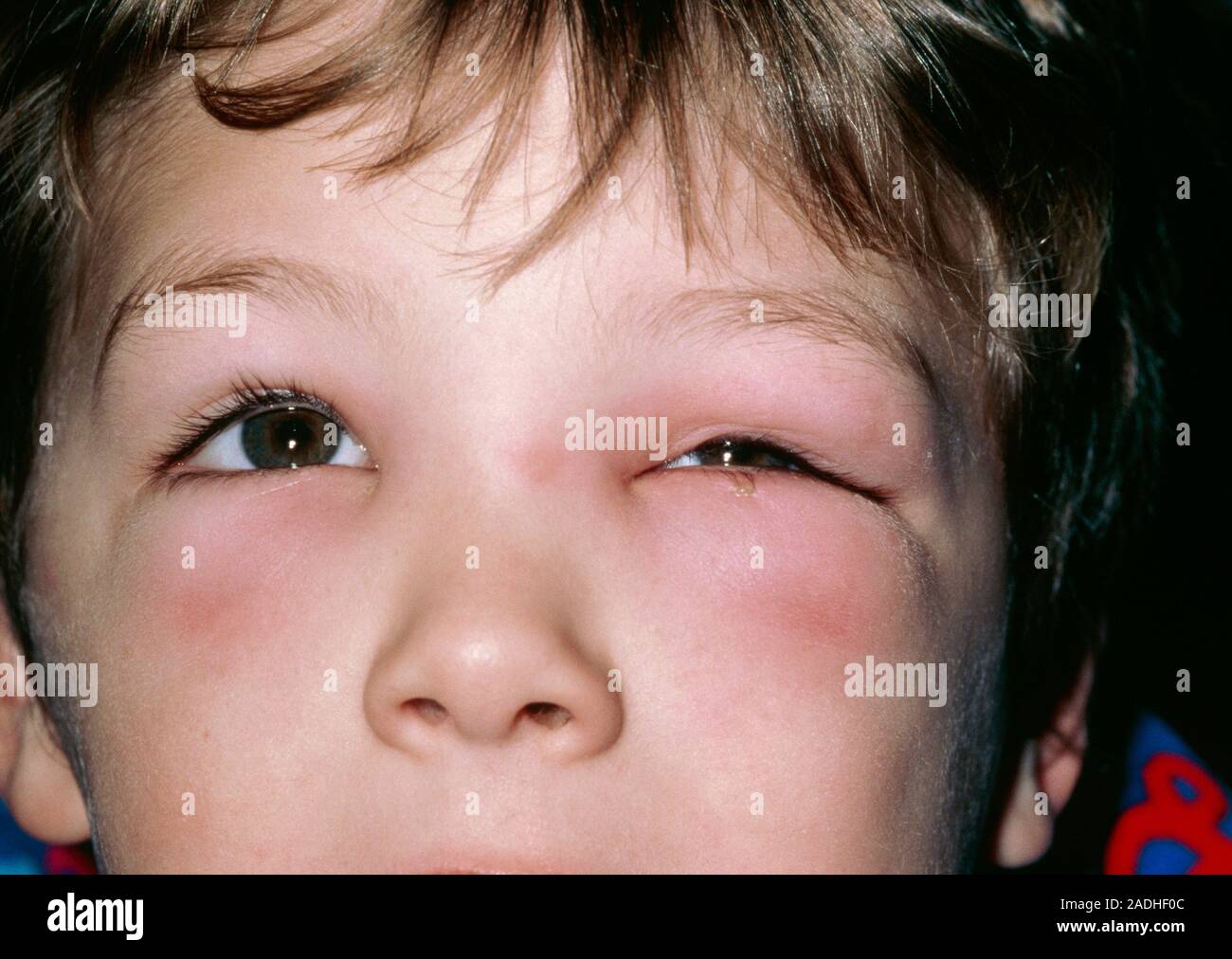 Eye disorder. Child affected by a periorbital oedema in both eyes, an ...