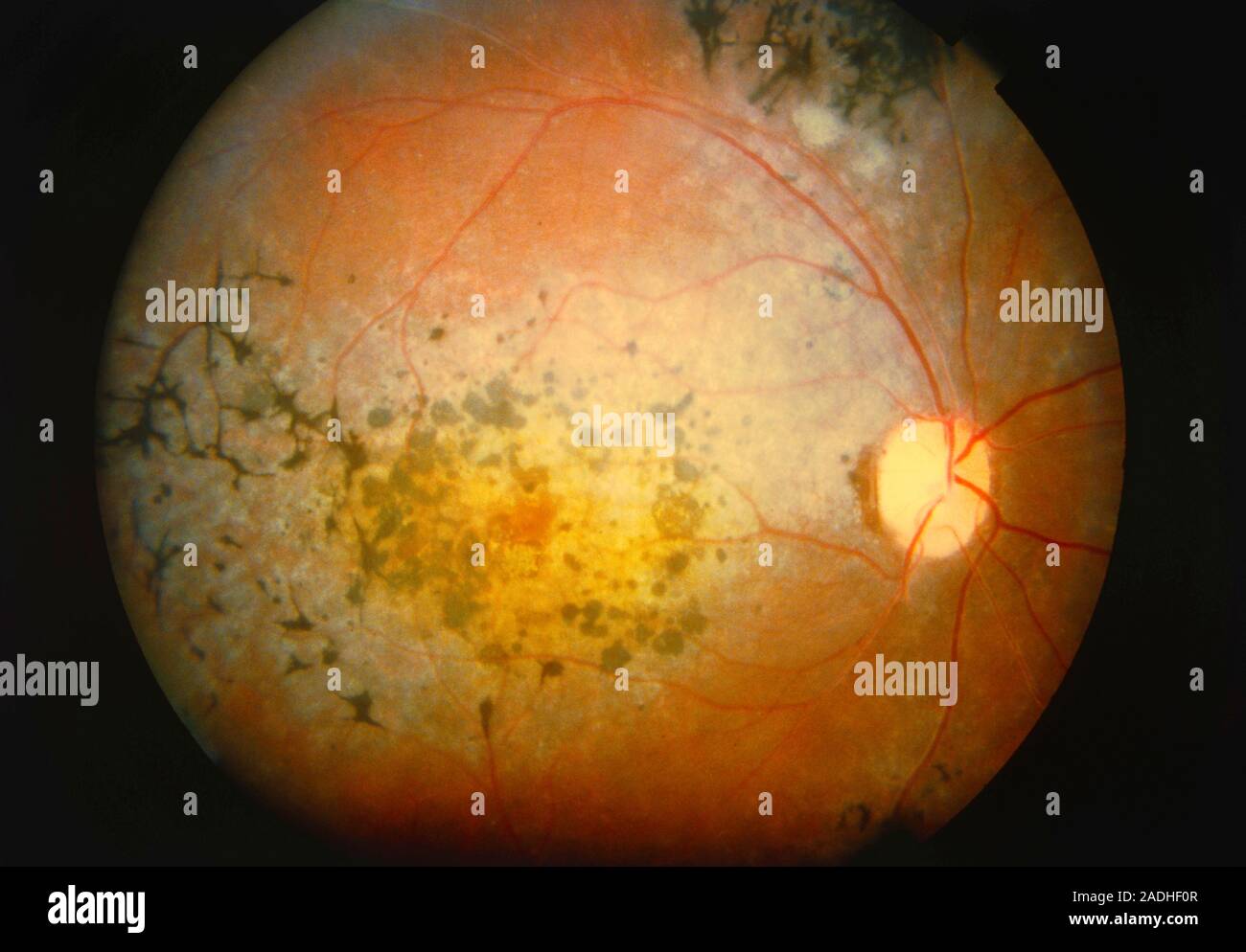 Retinitis pigmentosa: fundus camera image showing the degeneration of ...