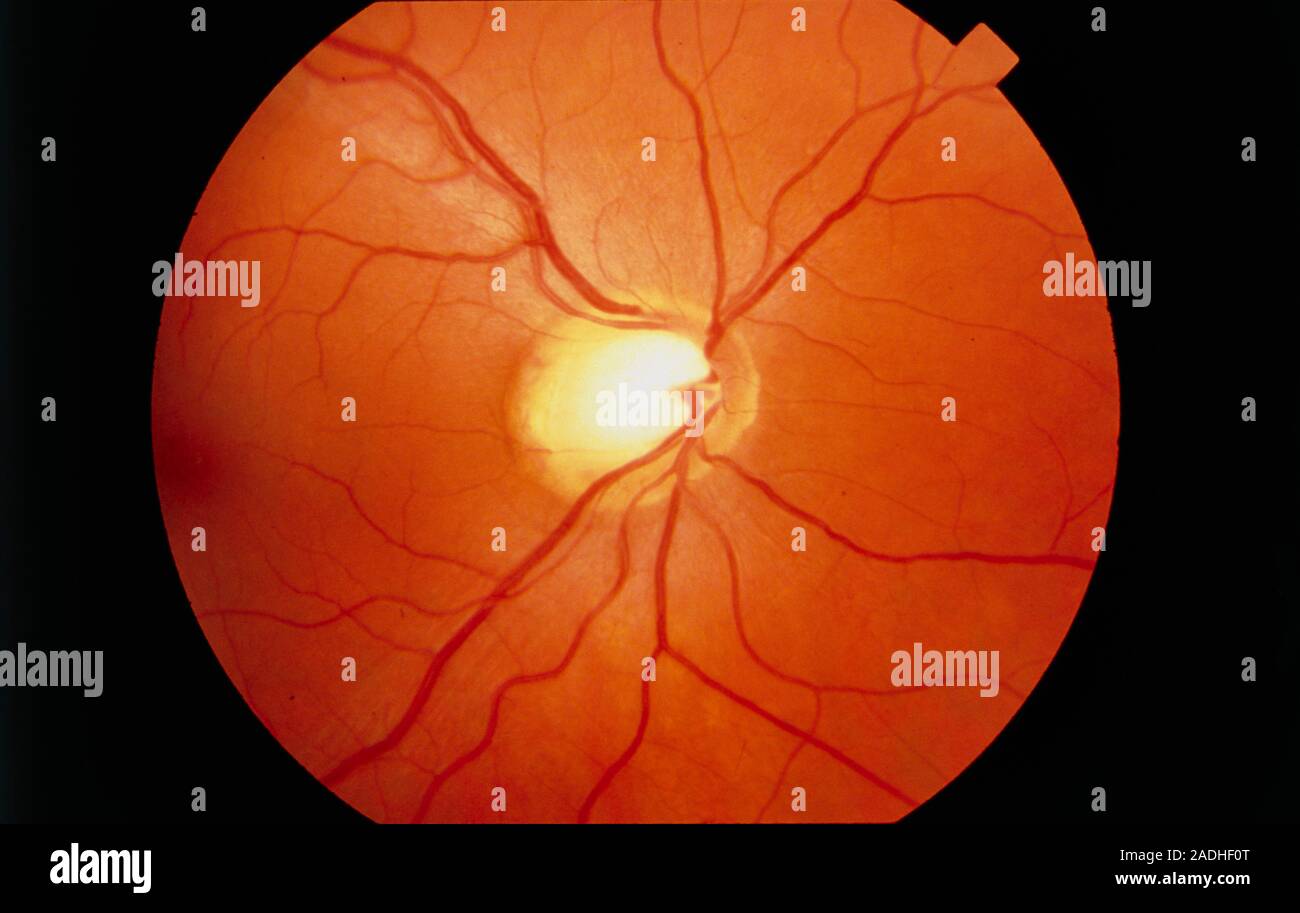 Fundus camera image of the retina in a case of glaucoma, showing ...
