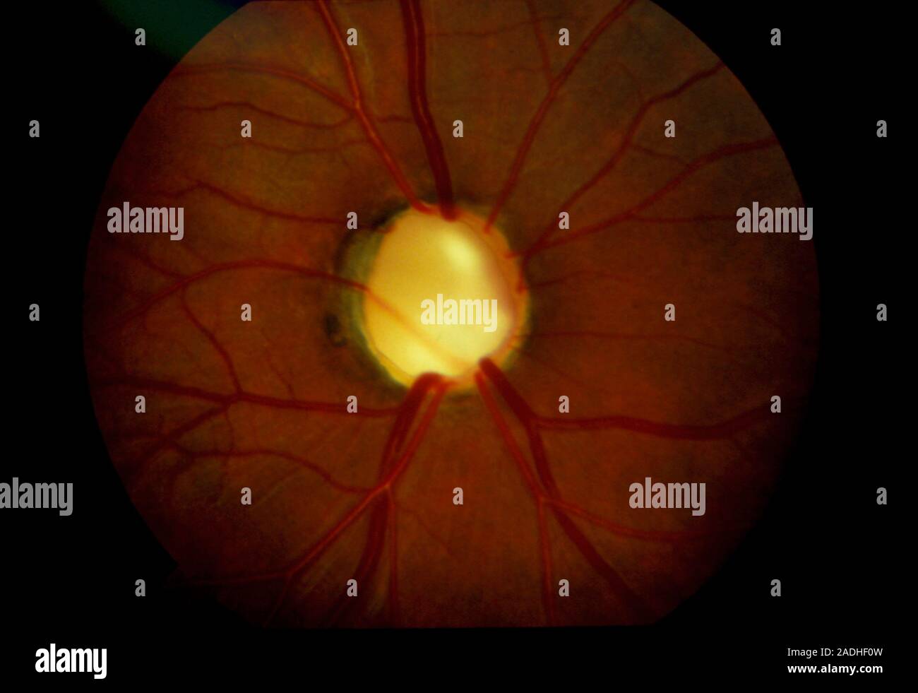 End Stage Glaucoma Fundus Camera Image Showing Cupping Of The Optic Disc The Vertical