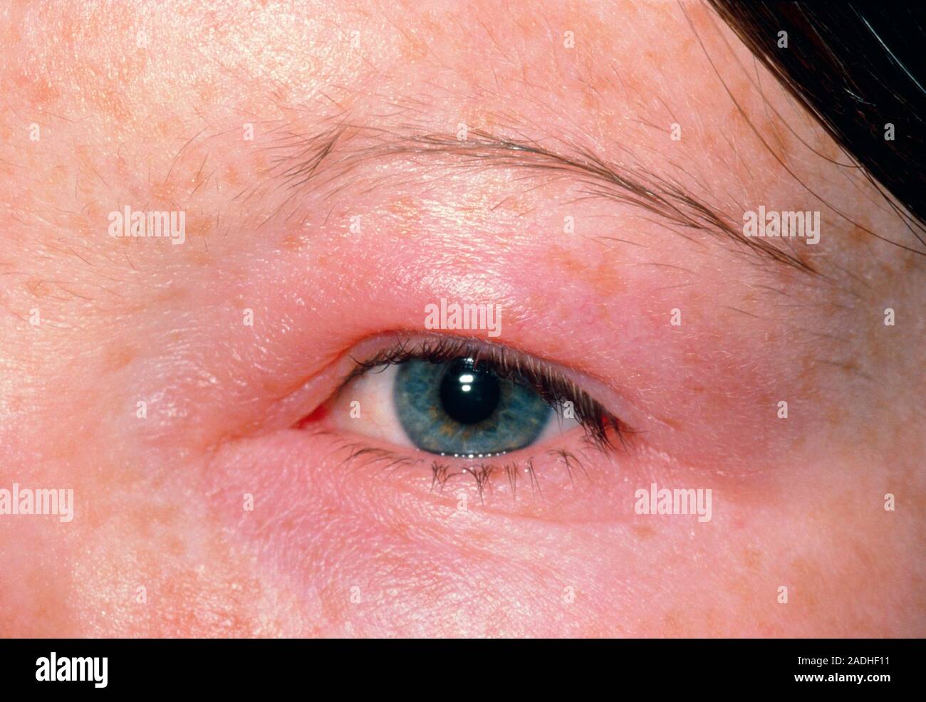Allergic swelling around eye. View of a patient's eye with swelling, as ...