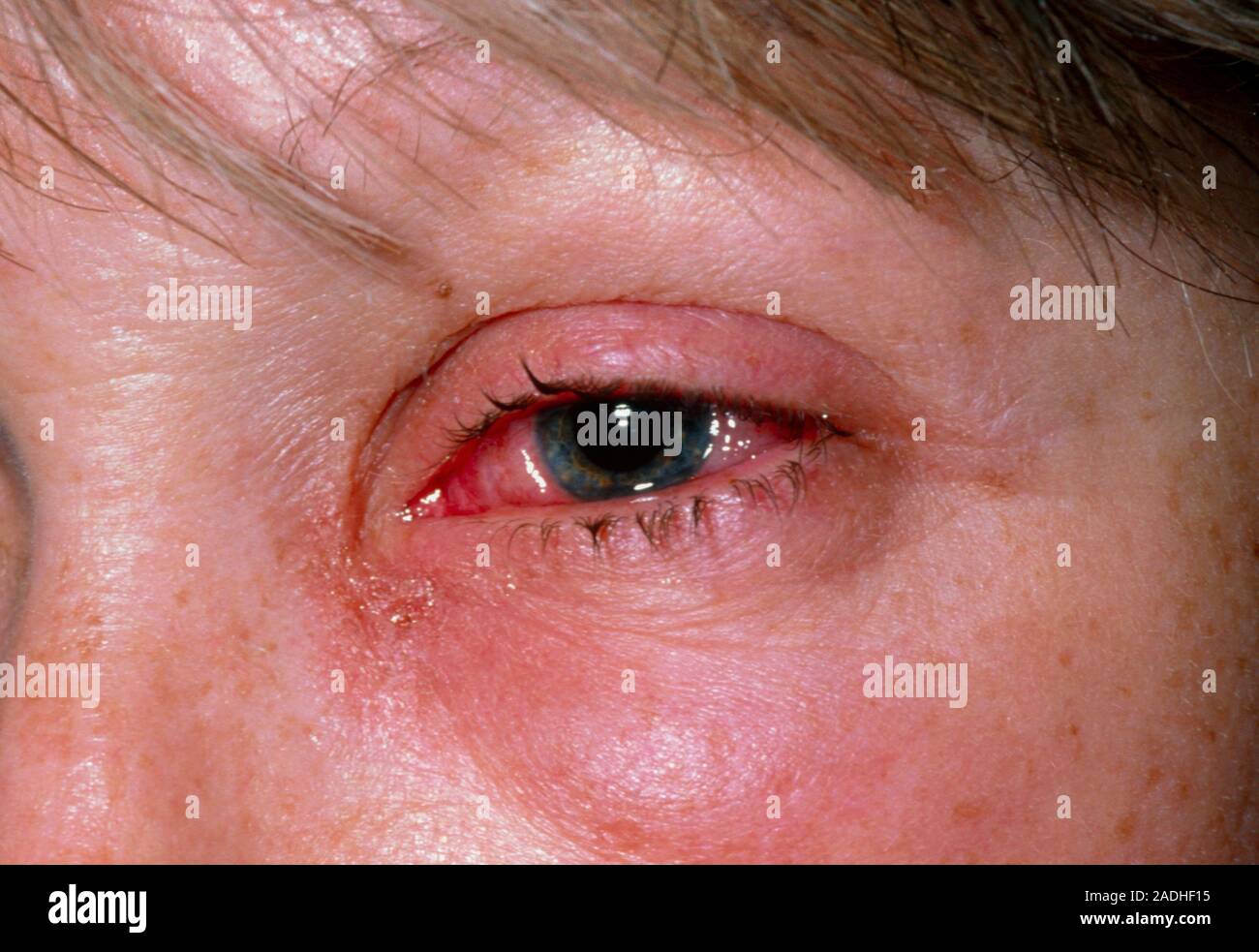 Viral conjunctivitis. View of a swollen and weeping eye caused by viral ...