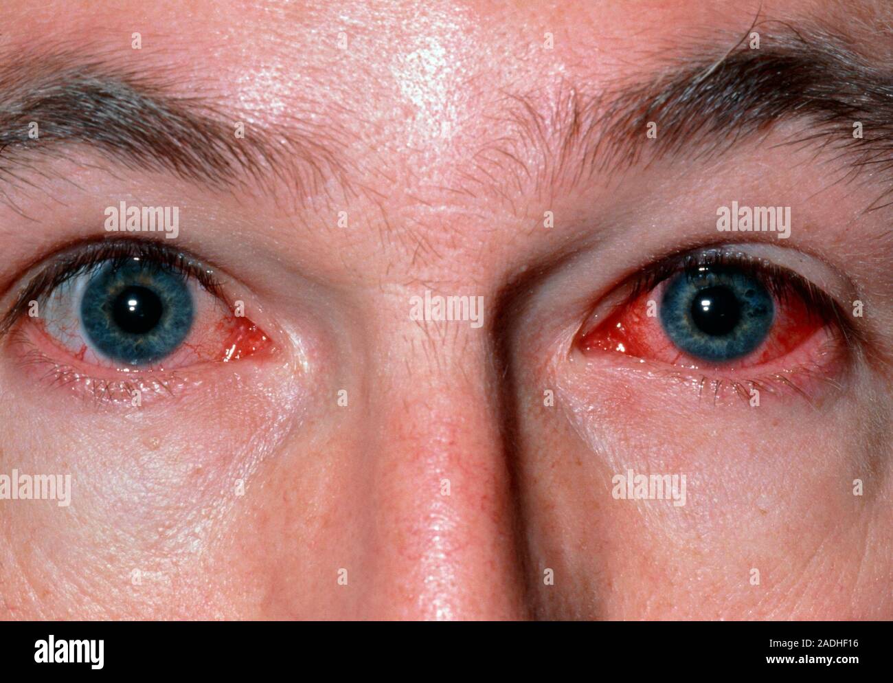 Viral conjunctivitis. View of inflamed eyes in a patient with viral ...