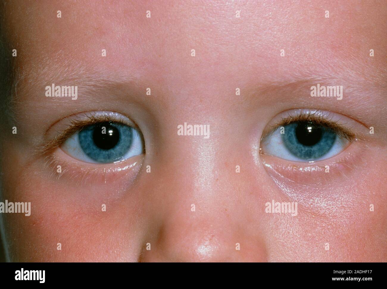 Epicanthic folds on normal child's eyes. View of vertical folds of skin ...