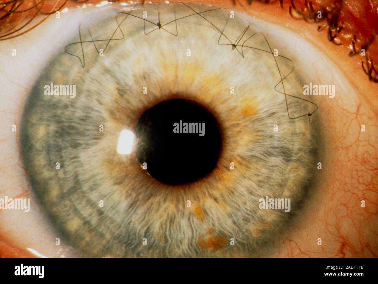 Post cataract surgery. Close-up of stitches in the eye after surgery ...