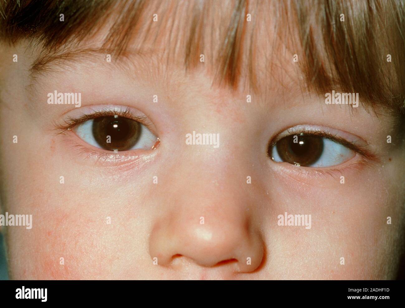 Convergent squint. Close-up of a child's face showing a convergent ...