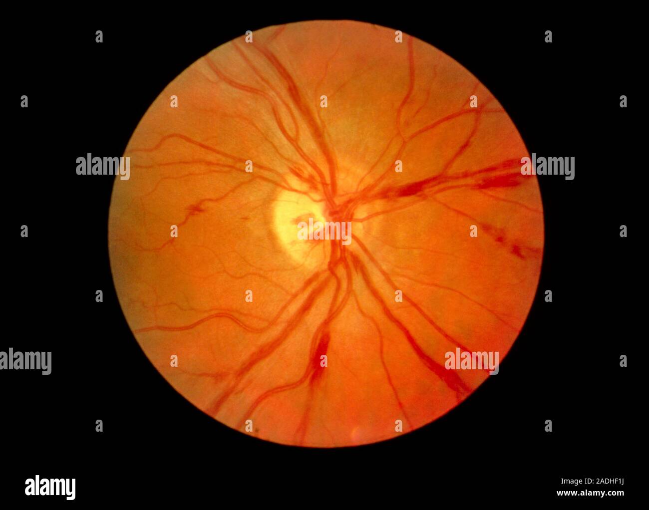 Retinal vasculitis. Ophthalmoscopy view of the retina of the eye ...