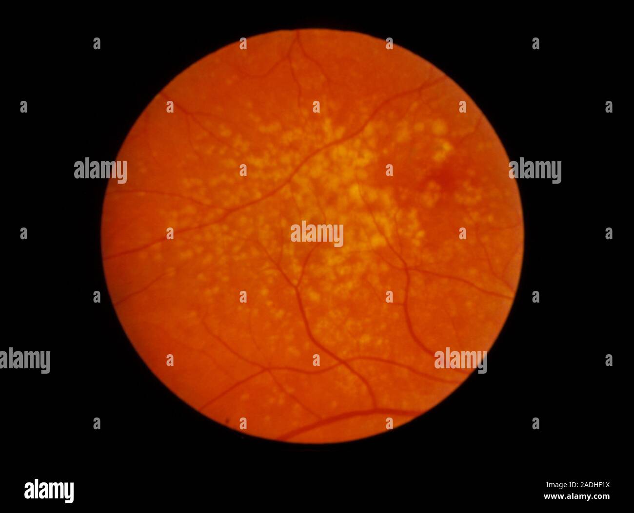 Drusen. Ophthalmoscope view of the retina of a patient's eye, showing ...
