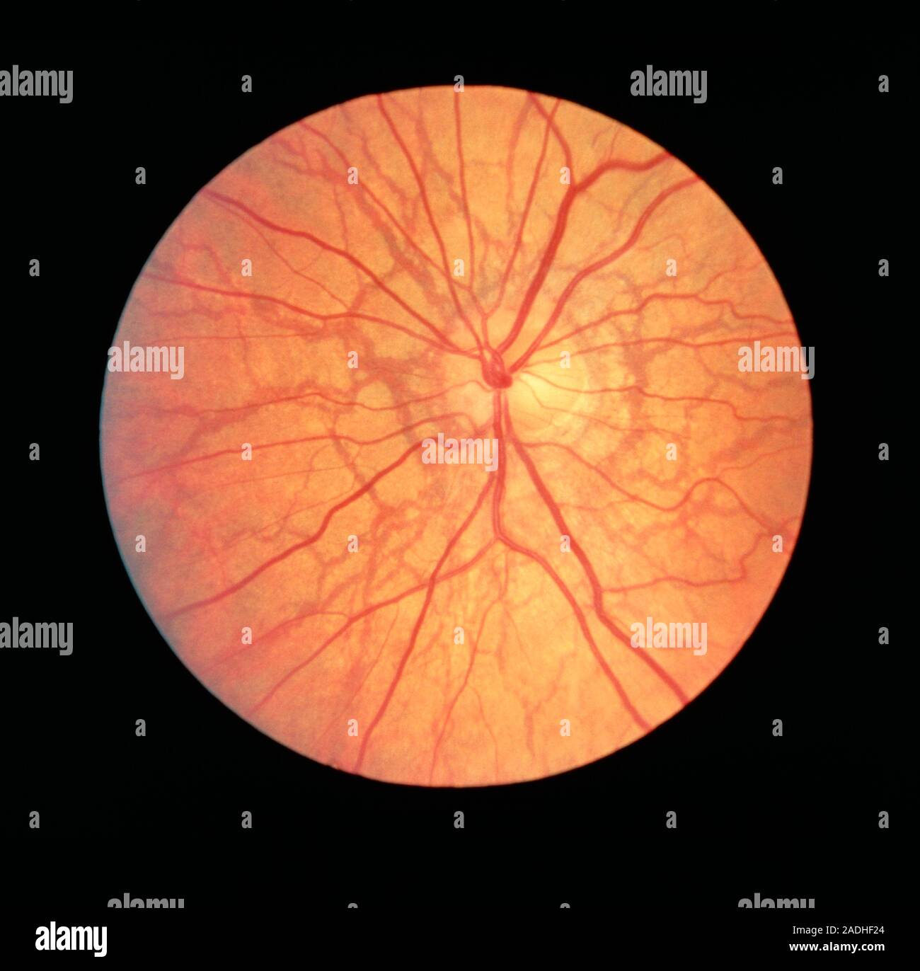 Angioid streaks (Pseudoxanthoma). Ophthalmoscope view of the retina of ...