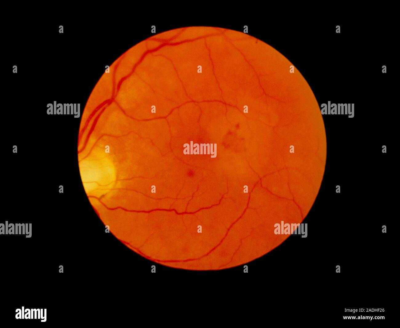 SRNVM macula degeneration. Ophthalmoscope view of the retina of a ...