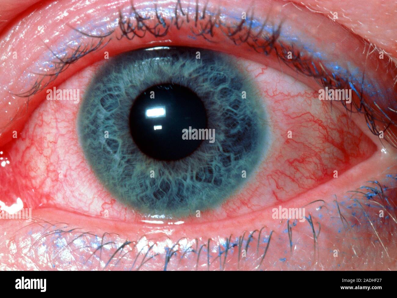 Viral conjunctivitis. Close-up of a bloodshot eye with viral ...
