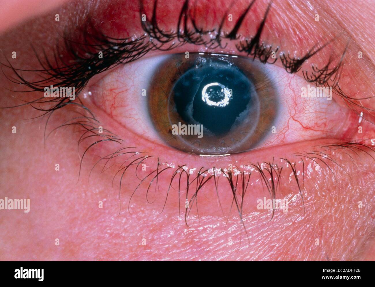 Rejecting corneal graft. Close-up of a man's eye showing tissue ...