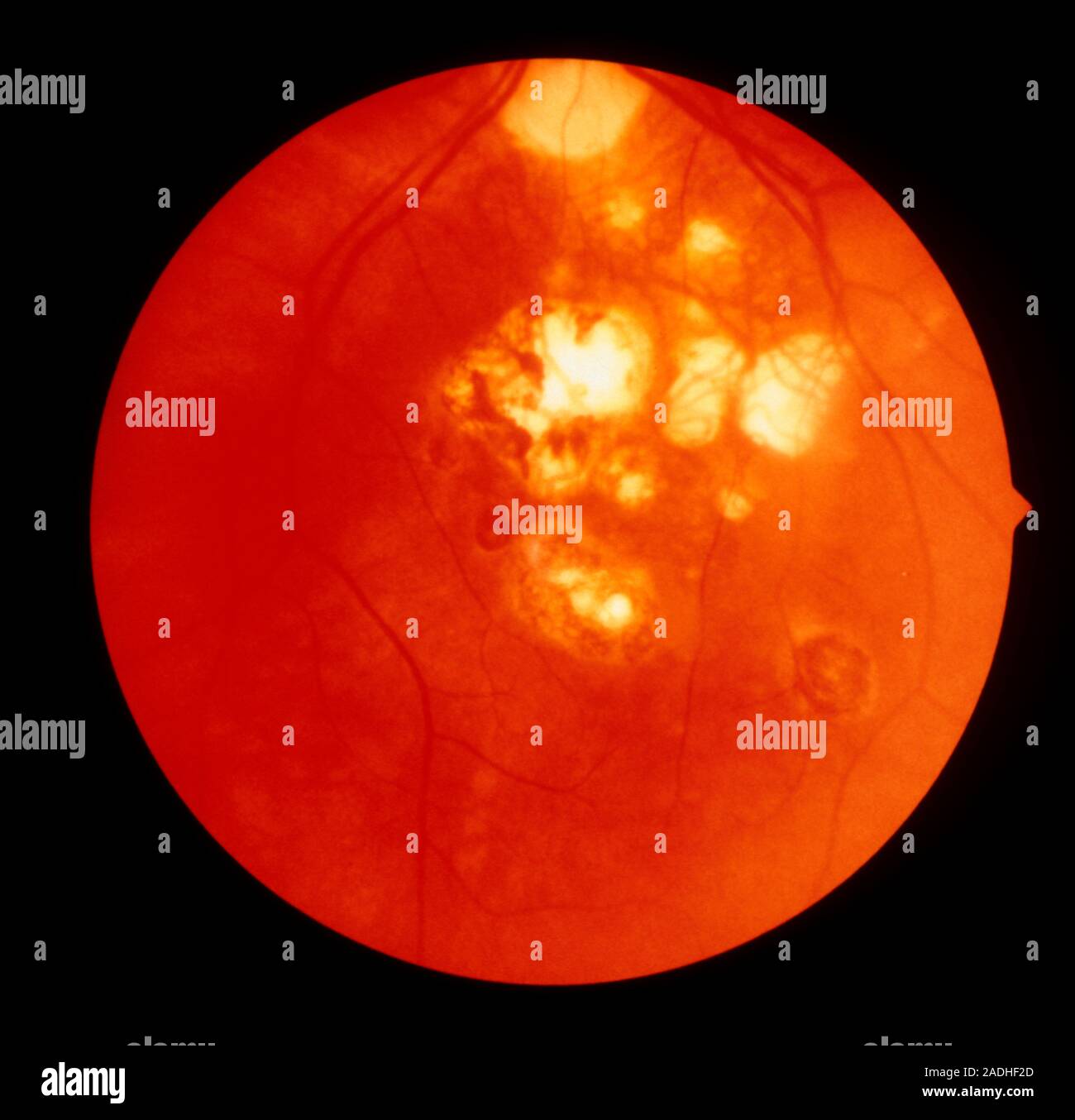 Toxoplasmosis of retina. Ophthalmoscope view of the retina of the eye ...