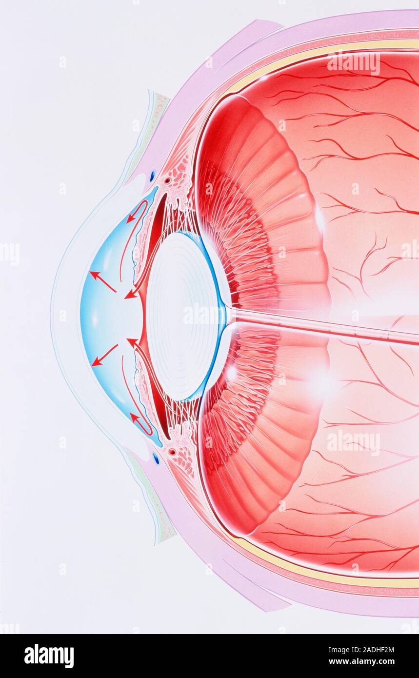 Glaucoma. Illustration showing flow of aqueous humour in the eye in ...