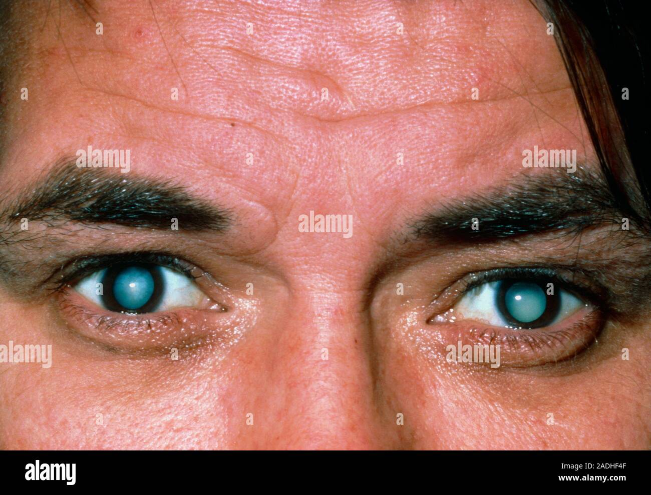Mature cataracts. Close-up of the eye's of a male patient with mature ...