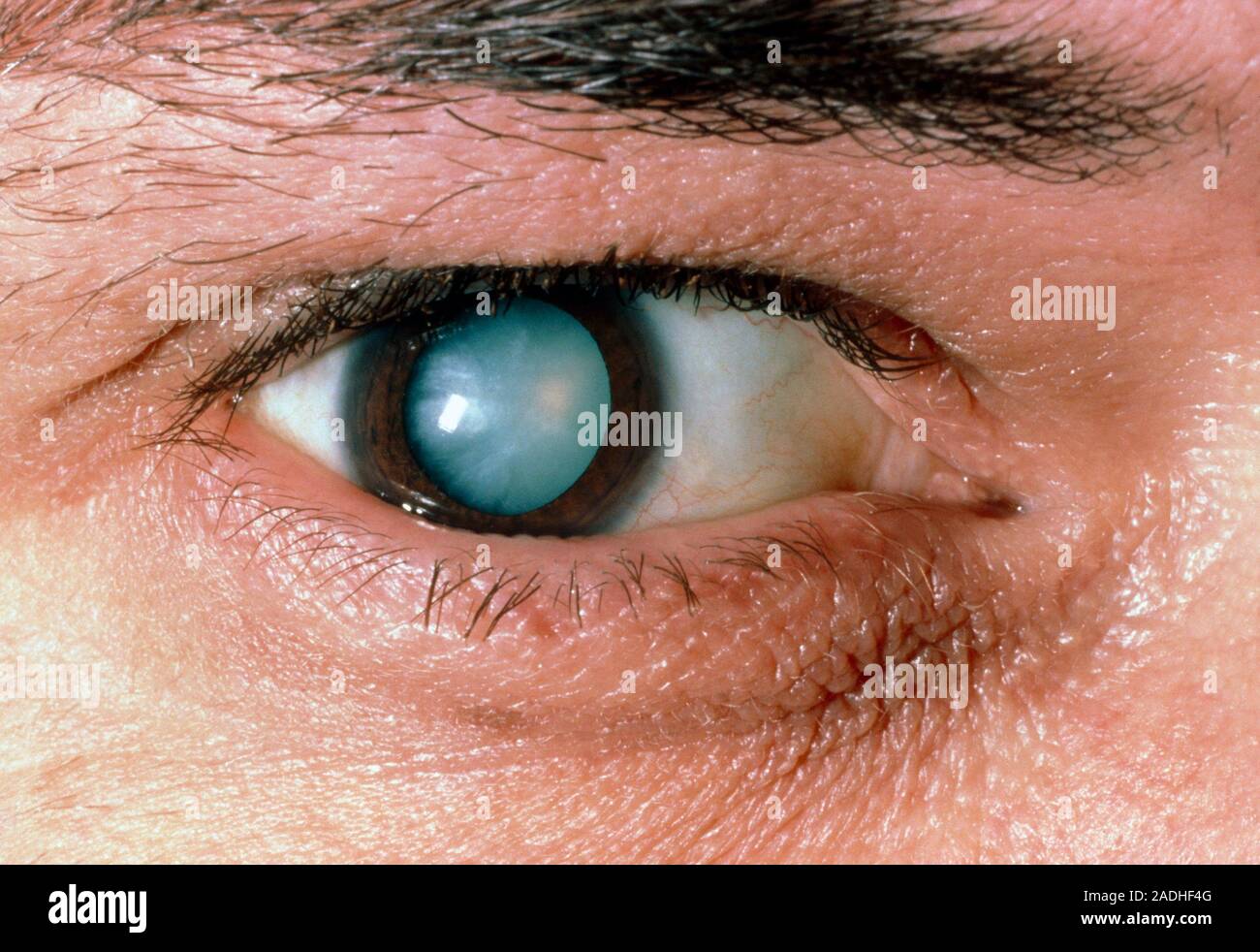 Cataracta Matura A Traumatic Mature Cataract (total White Cataract)