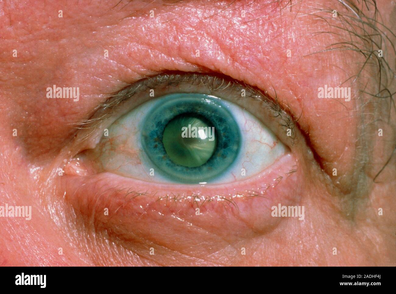 Trauma cataract. Close-up of the eye of a patient with a cataract ...