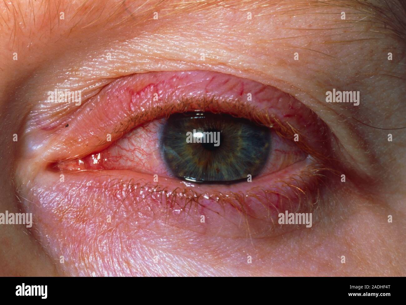 Acute Iritis Close Up Of A 30 Year Old Mans Left Eye With Iritis And Corneal Inflammation The