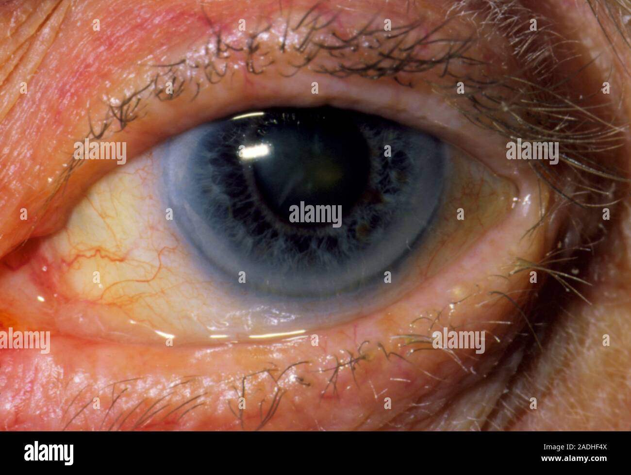 Mild cataract. Close-up of the eye of a 90 year- old female patient ...