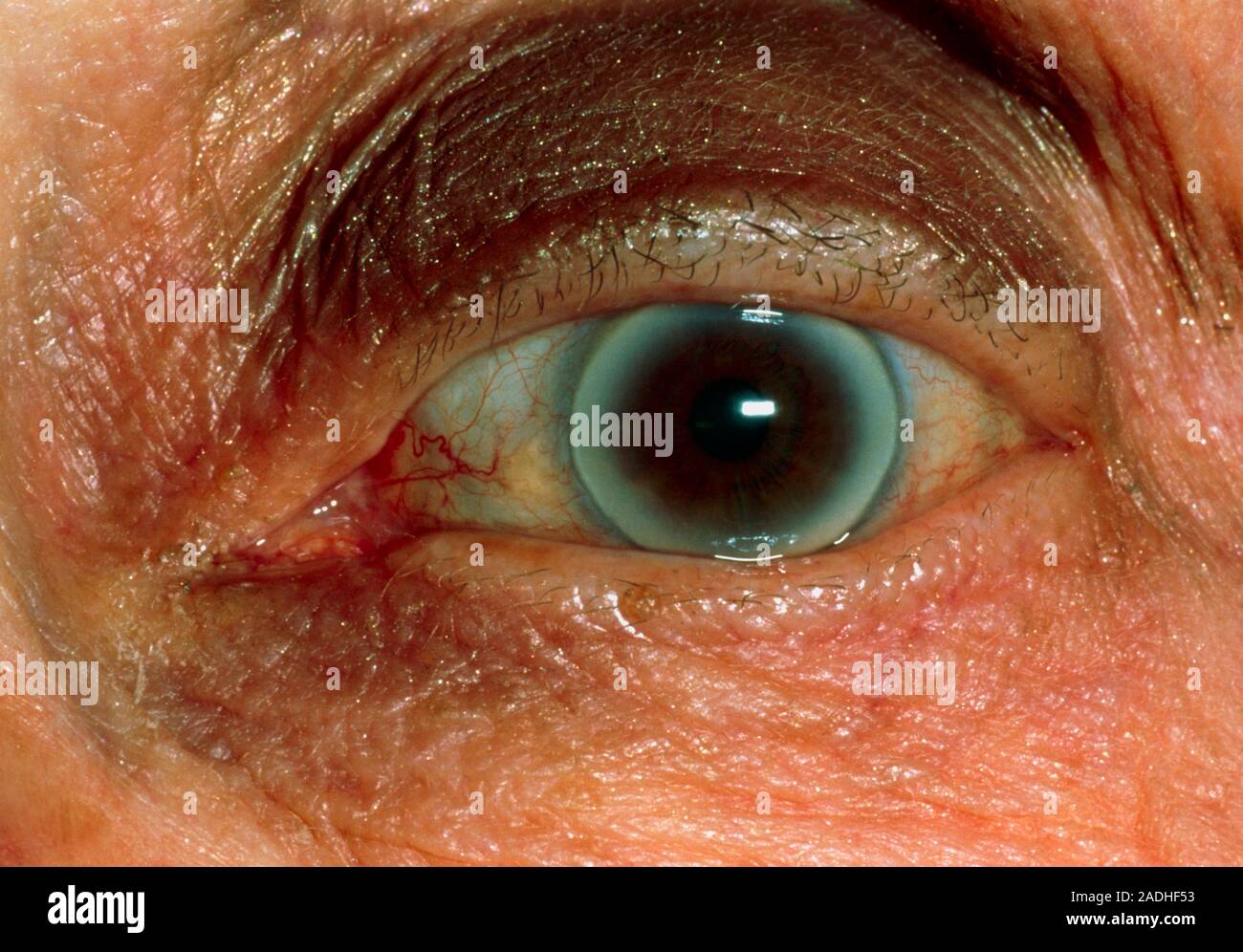 Arcus senilis. Close-up of the eye of an 82 year- old woman, showing ...
