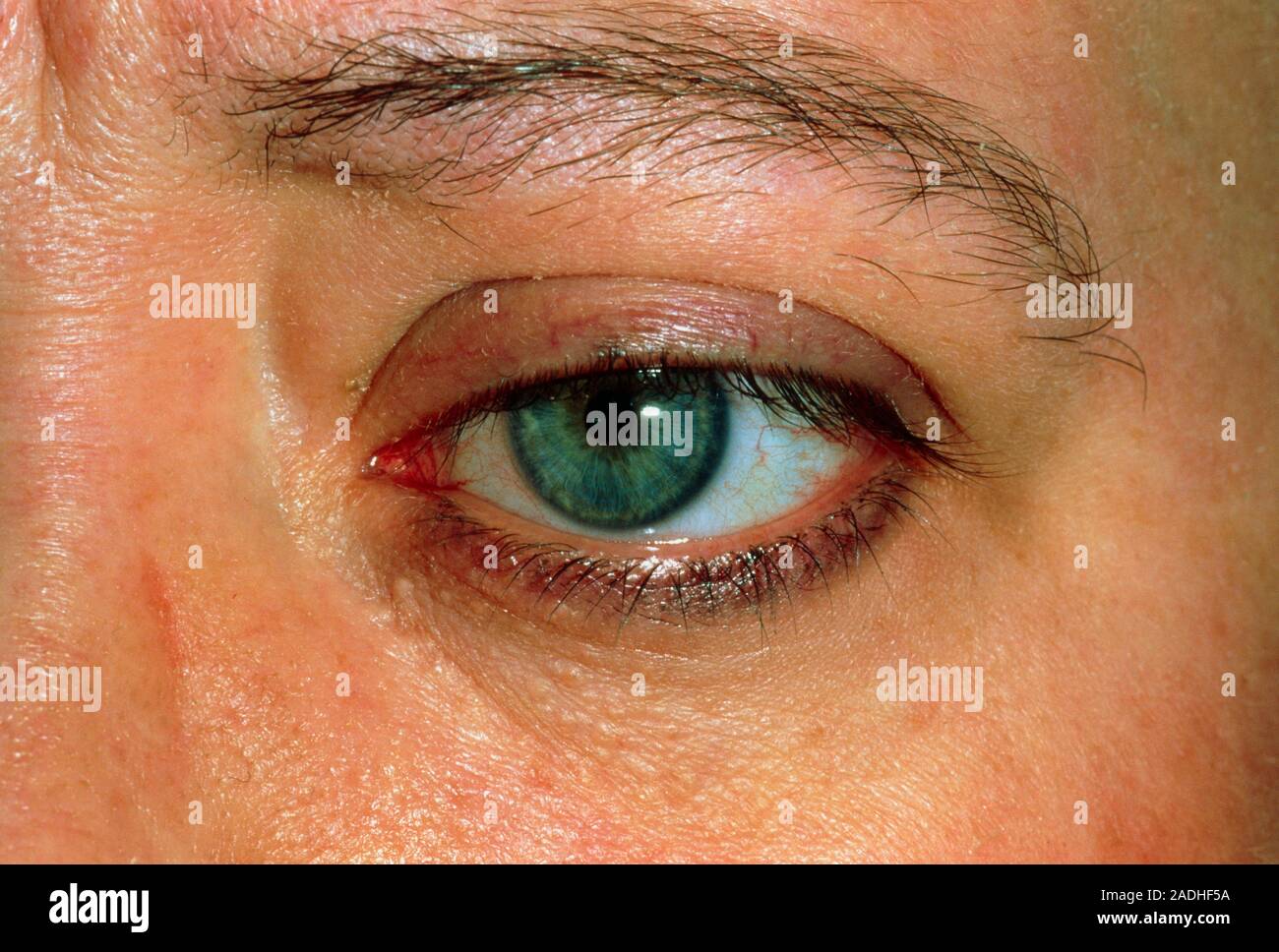 Eyelid disorder. Close-up of the partially retracted eyelid of 34 year ...