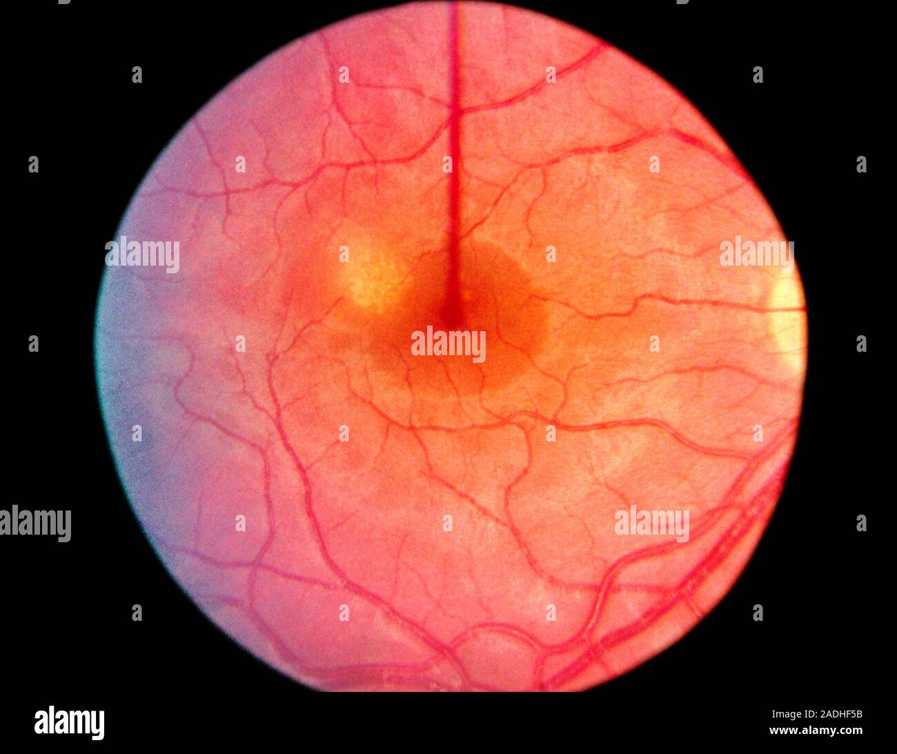 Heroin abuse. Ophthalmoscope view of the retina of the eye of a patient ...
