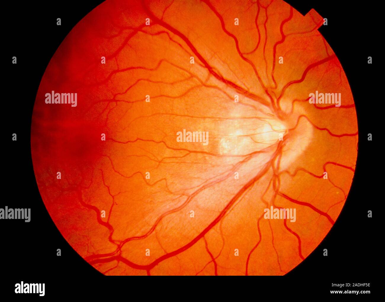 Retinopathy of prematurity. Ophthalmoscope view of a 50 year-old ...