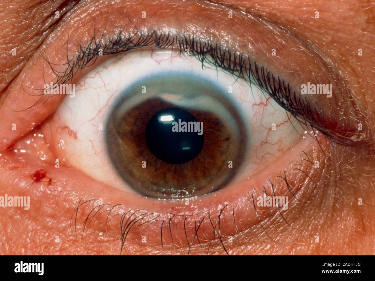 Keratitis. Close up of a 41 year-old female patient's eye with a light ...